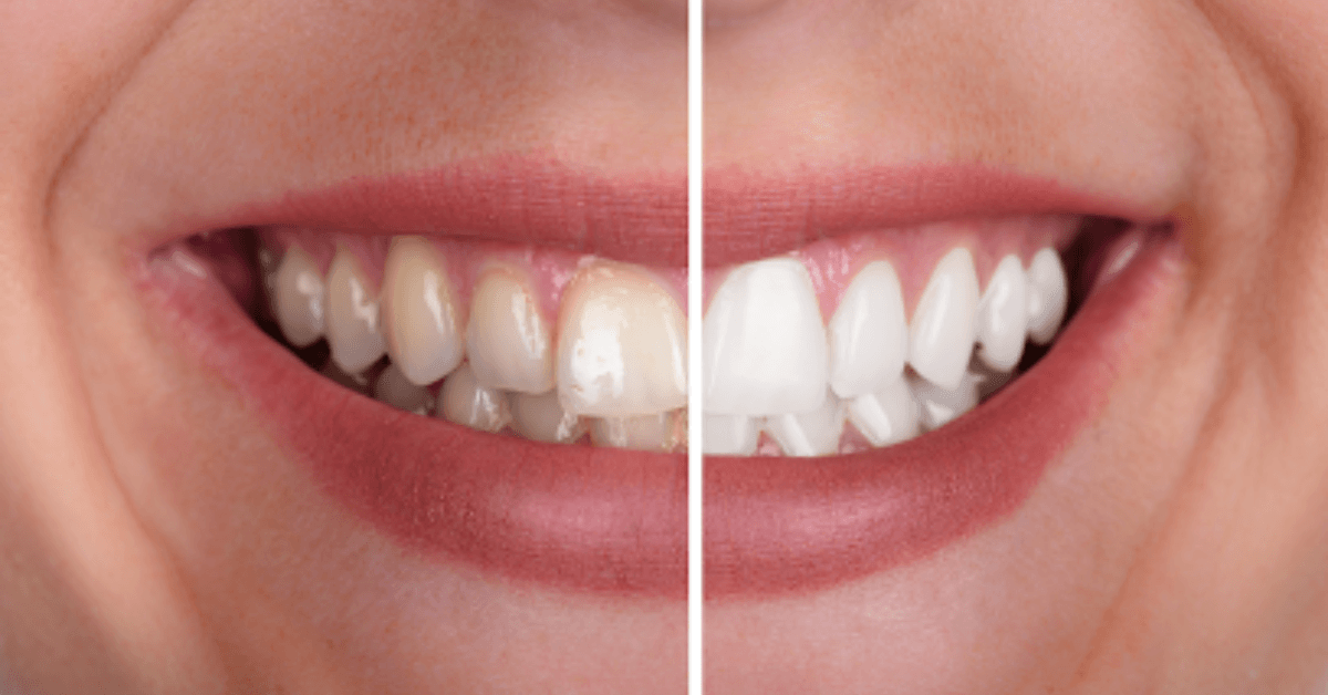 The Ripple Effect of a Radiant Smile on Self-Confidence – Lifestyle Net ...